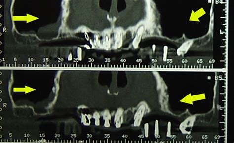 Dr Gustavo Hadad Sinusitis Maxilar Bilateral Post Cirugia Aumentativa