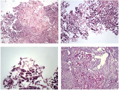 Mucormycose Histologie