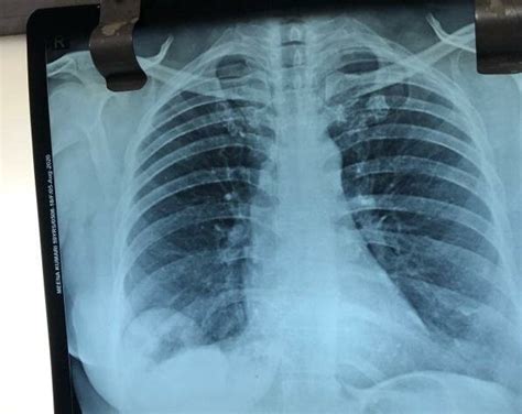Chest X Rays Shows A Well Defined Inhomogeneous Opacity Involving Right Download Scientific