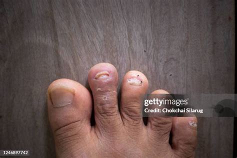 Photos Of Ringworm Photos And Premium High Res Pictures Getty Images