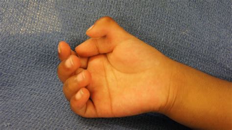 Chapter 2 Classifications Of Congenital Hand Deformities Appi America