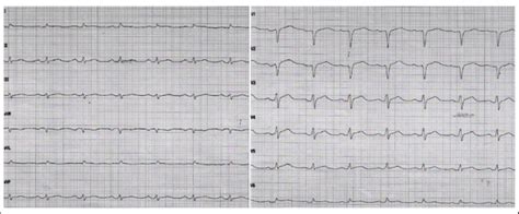 Electrocardiogram At Admission Showing St Segment Elevations In The