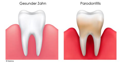 Parodontologie Zahnarztpraxis Dr Ravnik