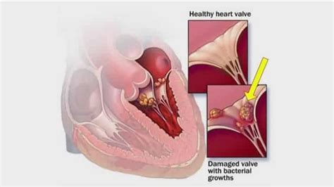Nonbacterial Thrombotic Endocarditis Key Points Capitol Cardiology