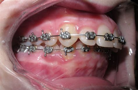 Overbite Before And After Orthodontic Braces Treatment