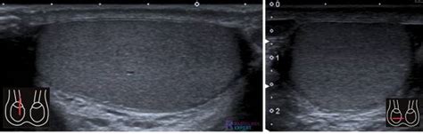 Echo Scrotum
