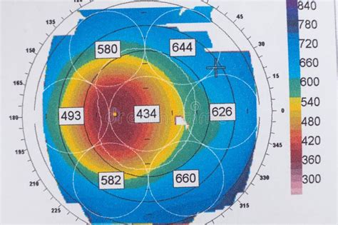 Results Of The Examination Of The Thickness And Curvature Of The Cornea