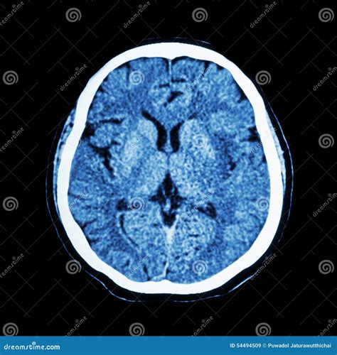 Ct Scan Of Brain Show Normal Humans Brain Cat Scan Stock Image 54494509