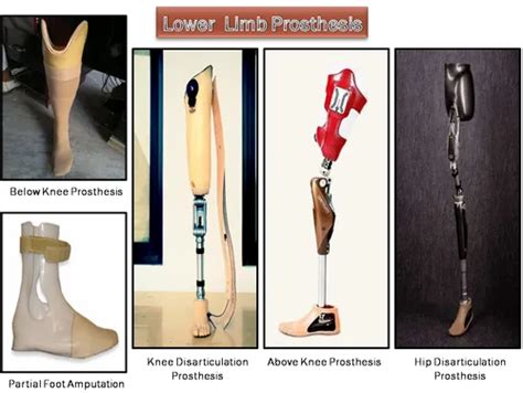Artificial Limbs Prosthesis At ₹ 50000piece Secunderabad Id