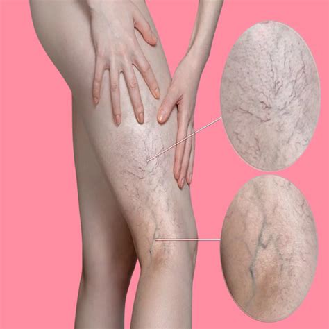 Dicynone 500 Mg 14 Tablets Rosheta Uae