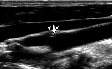 Contrast Enhanced Ultrasound For Assessing Carotid Atherosclerotic