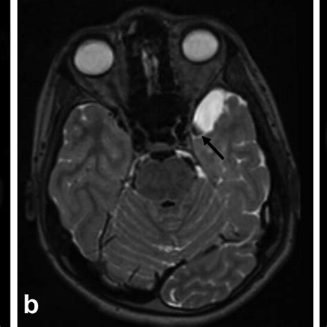 Galassi Classification A T2 Weighted Image Showing Type 1 Cyst White Download Scientific