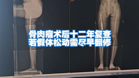 25岁女生骨肉瘤术后12年复查，假体松动需尽早翻修和延长，肺部ct复查未见异常。 骨肿瘤医生沈靖南 骨肿瘤医生沈靖南 哔哩哔哩视频
