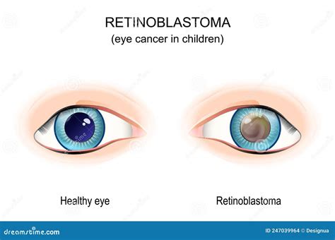 Retinoblastoma Drawing