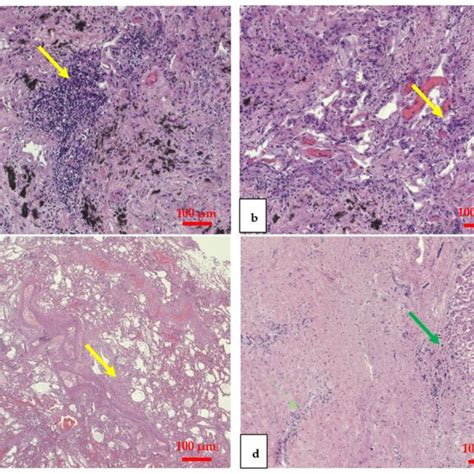 Hande X 10 Lungs Showed Interstitial Lympho Plasma Cell Infiltrate Download Scientific Diagram