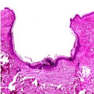 Pdf Dilated Pore Of Winer Dr Louis H Winer And Wine Glass