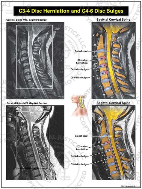 C3 C4 Disc Herniation Treatment Qpzo