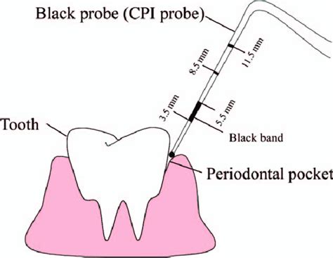 Dental Cpi Probe Used For Measuring Periodontal Pocket Depths Cpi