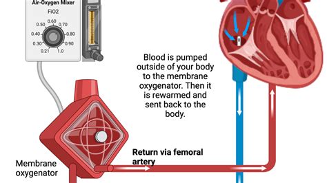 🌊 Fluid Management In Adult Patients Undergoing Va Ecmo 🌊