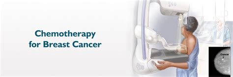 Chemotherapy For Breast Cancer Stages Indications And Side Effects