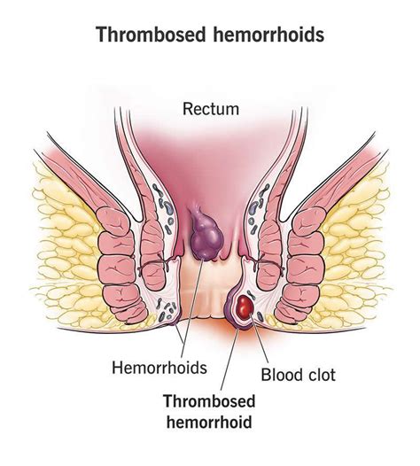 Thrombosed Hemorrhoids Symptoms Causes And Treatment Wockr