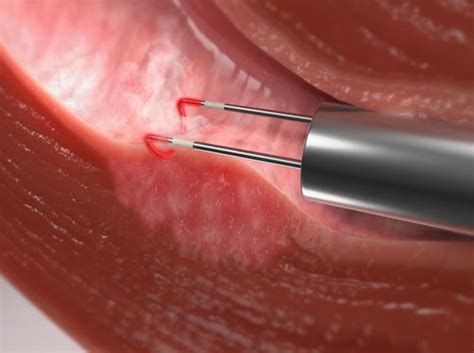 Video Hysteroscopic Myomectomy Healthclips Online