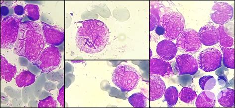 Faggot Cells In Acute Promyelocytic Leukemia