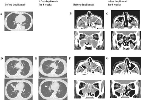 Chest Computed Tomography Ct Shows Bronchial Wall Thickening In The