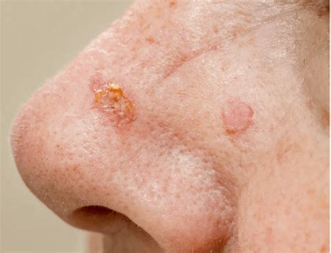 Basal Cell Cancer Itchy At Jane Whitsett Blog