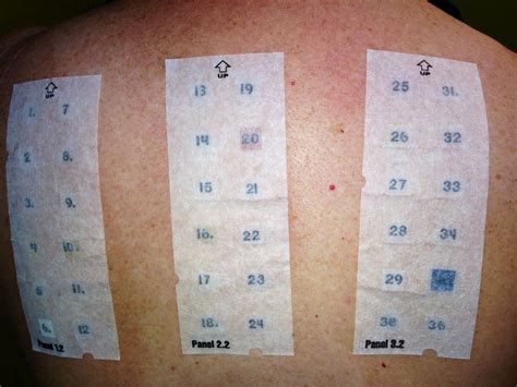 When Do I Need A Patch Test Patch Tests Skin Contact Allergy Tests