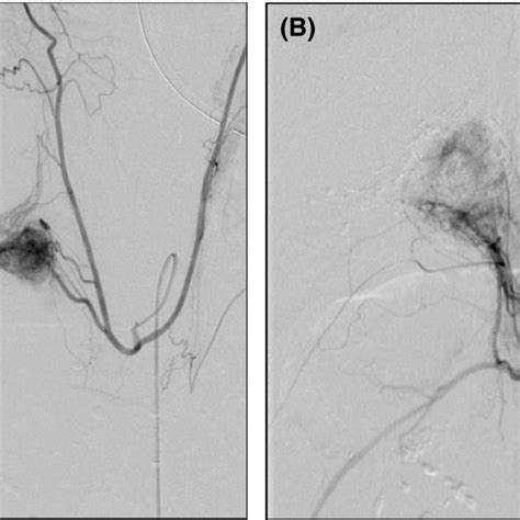 Ct Fluoroscopy Axial Image During Rfa Adrenal Radiofrequency Ablation Download Scientific