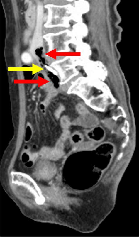 Catheter Related Gas Forming Suppurative Thrombophlebitis Pmc