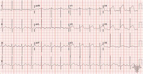 Left Ventricular Hypertrophy Ecg Stampede