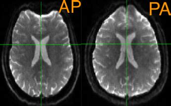TBSS Topup And Eddy Andy S Brain Book Documentation
