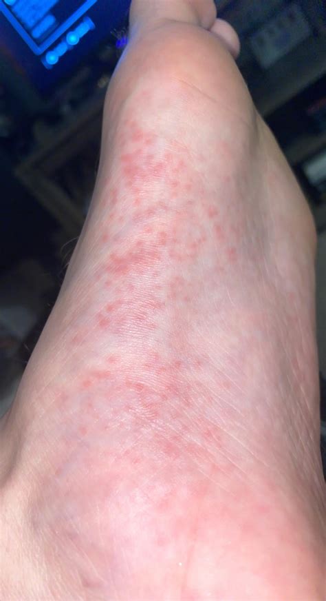 Have Had Itchy Feet In The Bottommiddle Area Of The Foot Both Feet