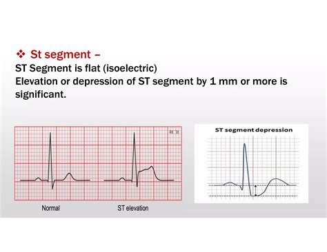Ecg Understanding And Interpretation Pdf