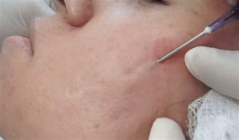 Subcision Treatment For Scars Tadawi Medical Center