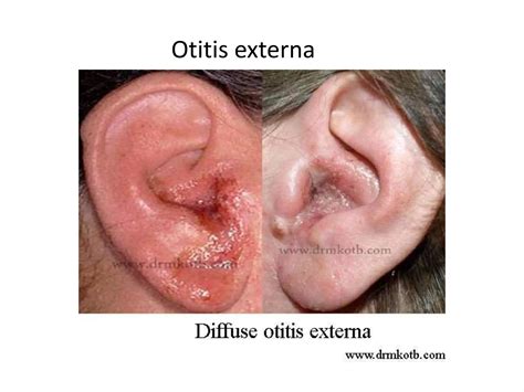 Different Ear Condition Ppt