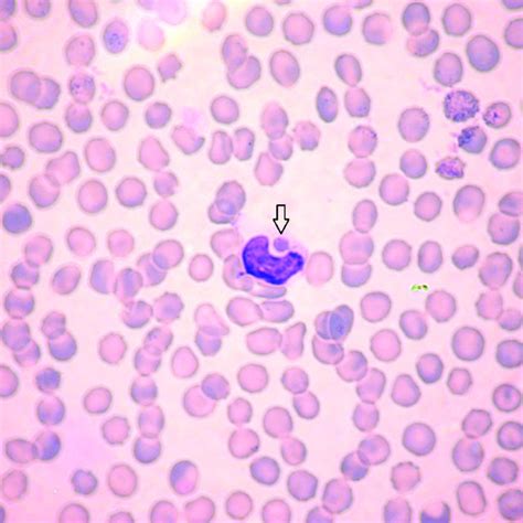 Blood Smear From A Dog One Hypersegmented Neutrophil Arrow Is