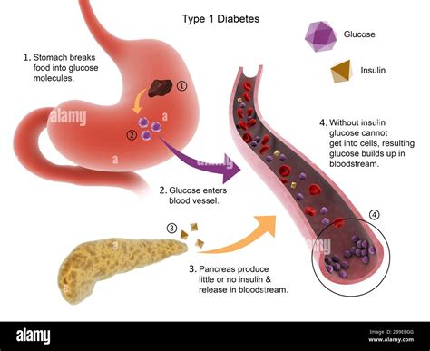 Type 1 Diabetes Pancreas