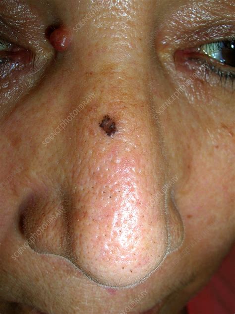 Pigmented Basal Cell Carcinoma Stock Image C0564964 Science