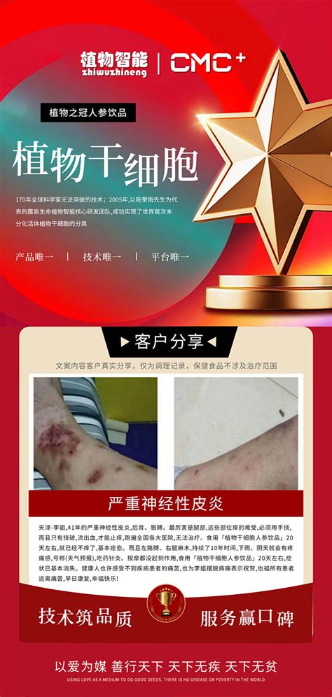 严重神经性皮炎