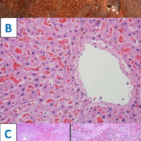 Cardiac Congestive Hepatopathy A Gross Photograph Of A Liver With