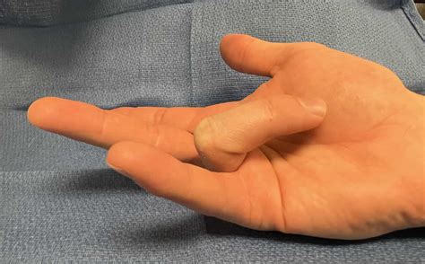 Trigger Finger Definition Etiology Symptoms Diagnosis Evaluation And