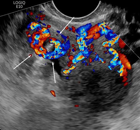 Ovarian Torsion Ultrasound