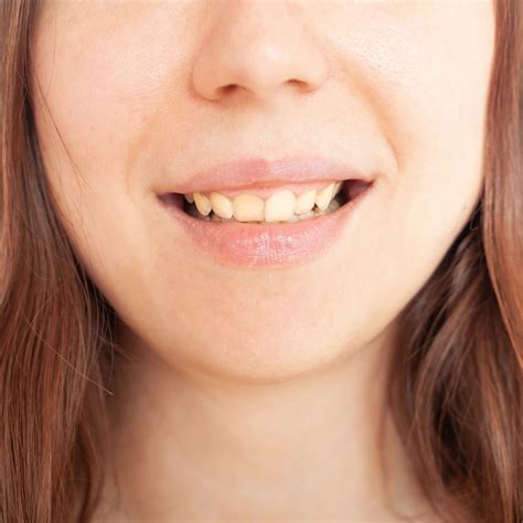 Dental Bonding Subiaco The Colonnade Dental Subiaco