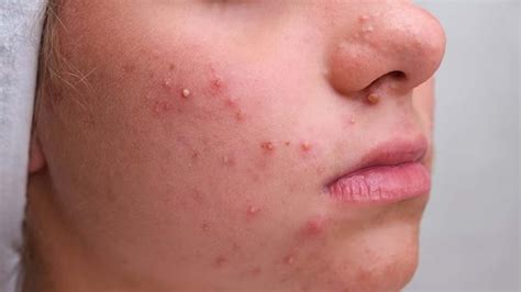 Can Hormonal Imbalance Cause Pimples