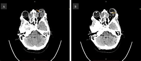 Cect Brain And Orbit A Axial Scan Showing Heterogeneous Mass Arising Download Scientific