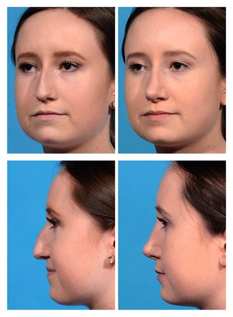 Tip Rhinoplasty Before And After Photos