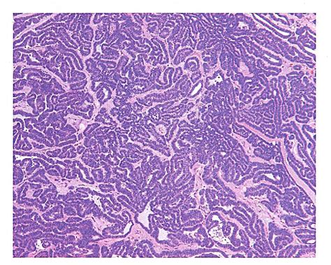 Canalicular Adenoma Semantic Scholar